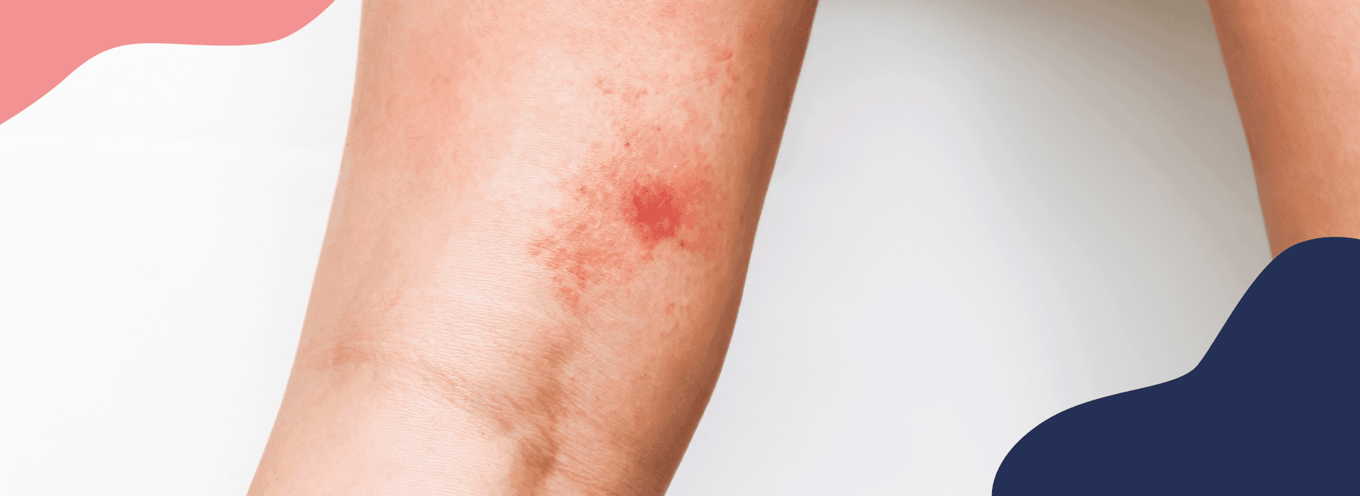 Dermatitis Atópica - Alergomed