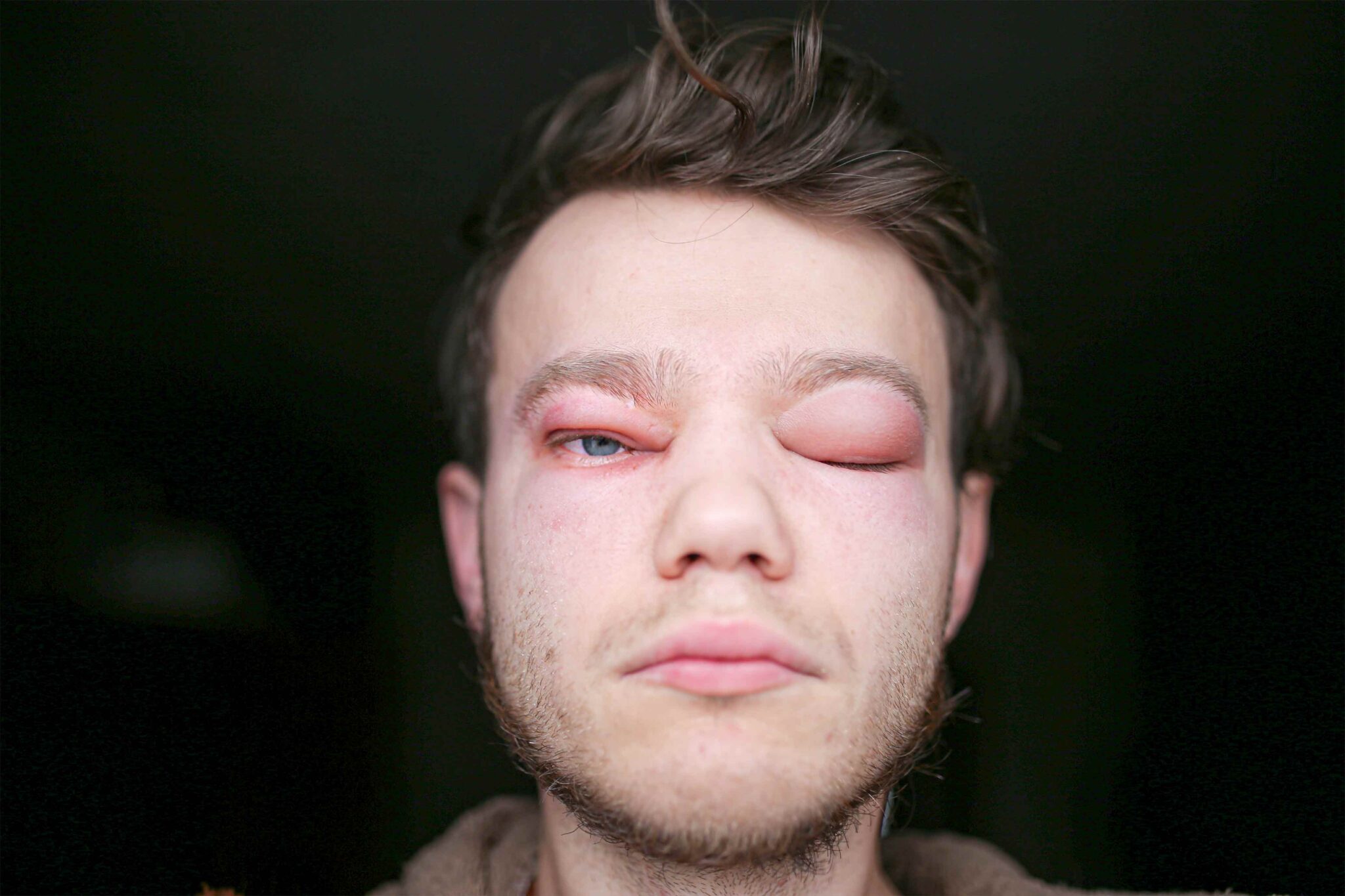 Urticaria y Angioedema - Alergomed