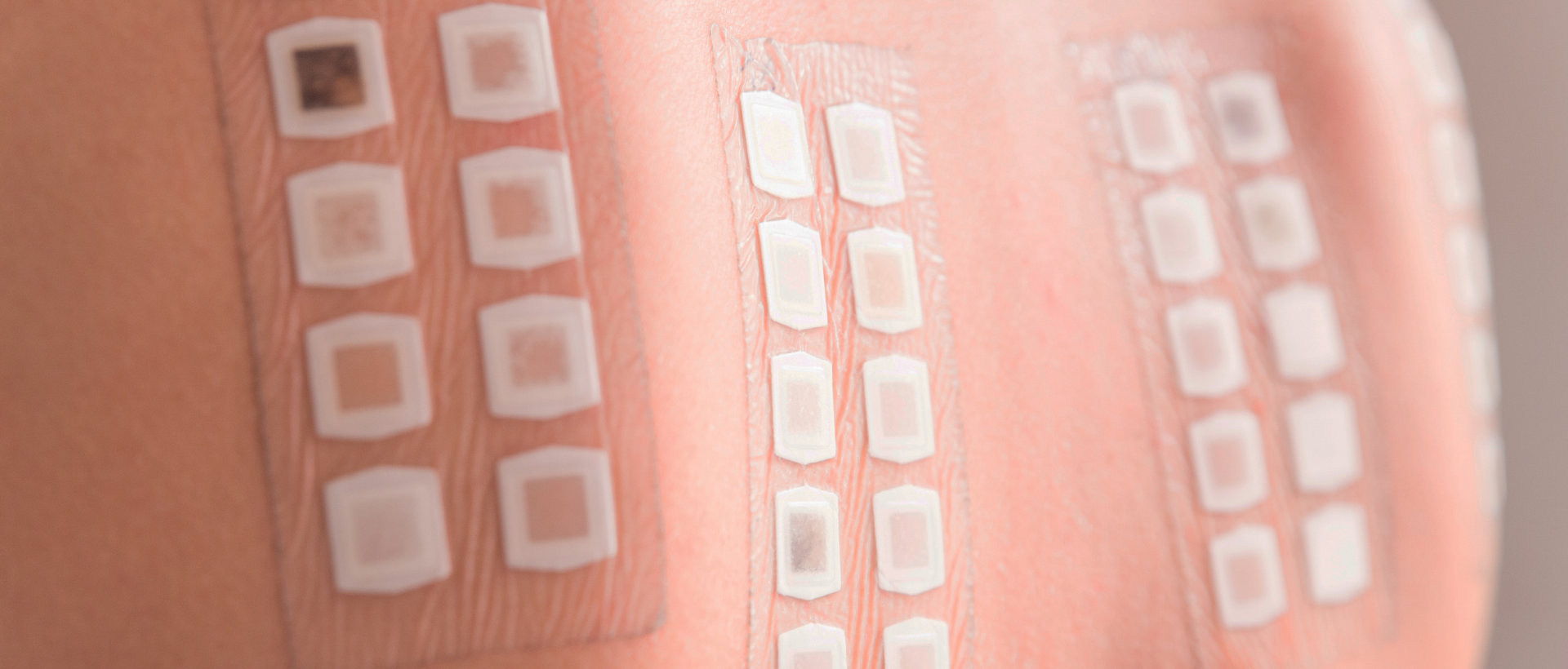 Prueba de Parche Diagnóstico de Alergias Alimentarias