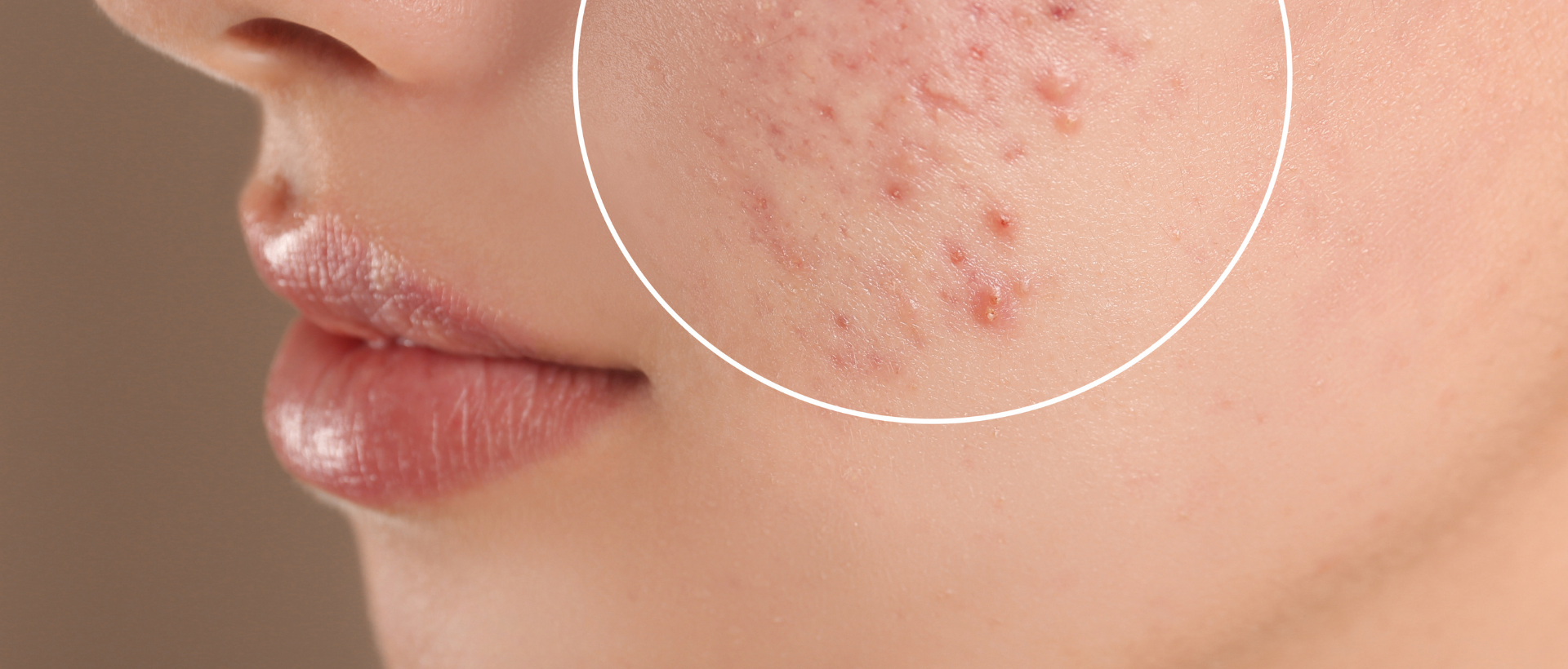 Tratamiento del Acné en Alergomed