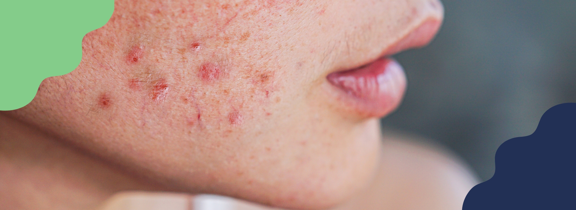 Tratamiento del Acné en Alergomed